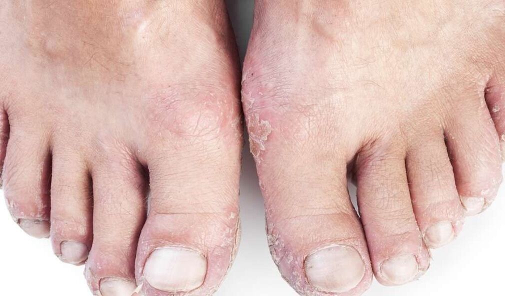 Trattamento dei funghi tra le dita dei piedi con rimedi popolari: ricette efficaci per unguenti ...